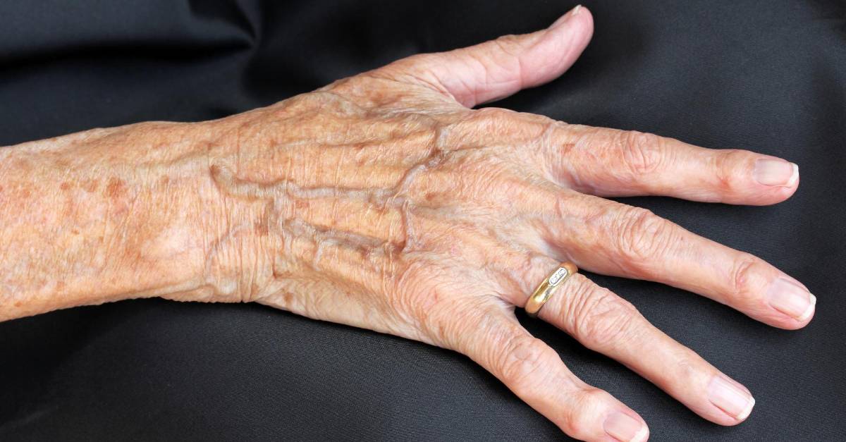 Lunares de manos y pies pueden ser cancerígenos